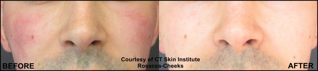 Rosacea Treatments from the Connecticut Skin Institute
