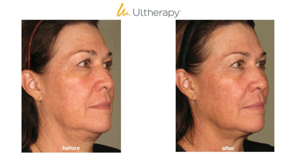 Ultherapy: Non-Invasive Skin Tightening - Connecticut Skin Institute