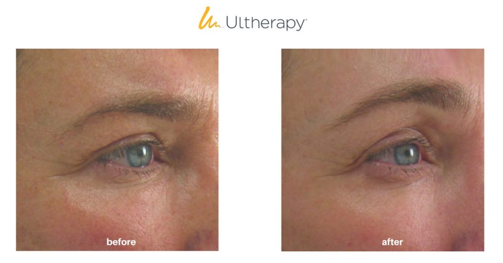 Ultherapy: Non-Invasive Skin Tightening - Connecticut Skin Institute