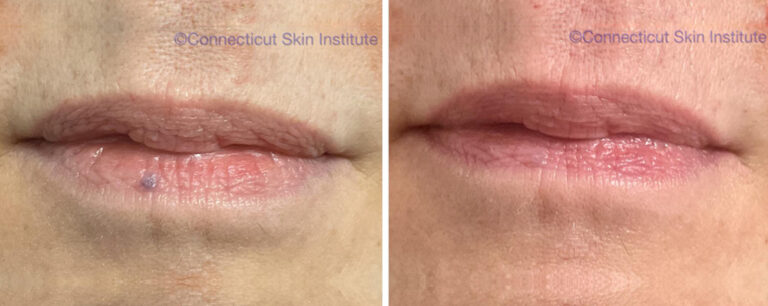 Venous Lake - Connecticut Skin Institute
